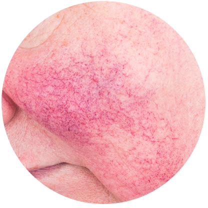 Skin Conditions - Canadian Dermatology Association